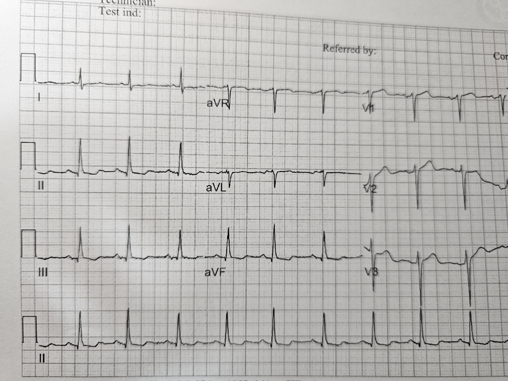NSTEMI 진단 기준이 어떻게 되나요? 아래 자료가 진단기준에 부합한지 궁금합니다. ㅣ 궁금할 땐, 아하!